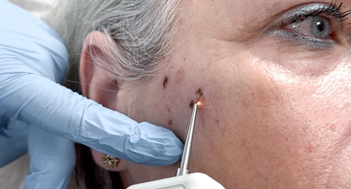 Zapper / Coagulatietherapie | Be-Smooth Huid & Beauty Instituut